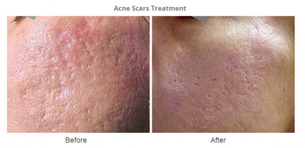 Acne & Acne Scar Revision - BeauTouch Medi-Aesthetics Clinic