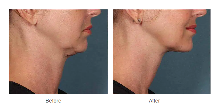 Belkyra® - BeauTouch Medi-Aesthetics Clinic