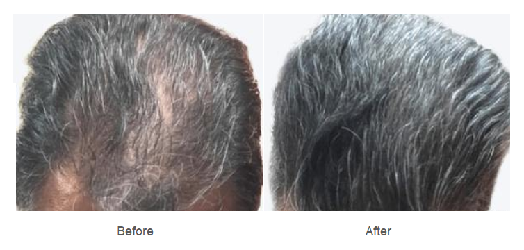 Laser Hair Restoration - BeauTouch Medi-Aesthetics Clinic