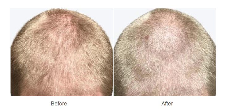 Laser Hair Restoration - BeauTouch Medi-Aesthetics Clinic