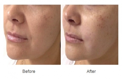 Intraoral Face Lifting - BeauTouch Medi-Aesthetics Clinic